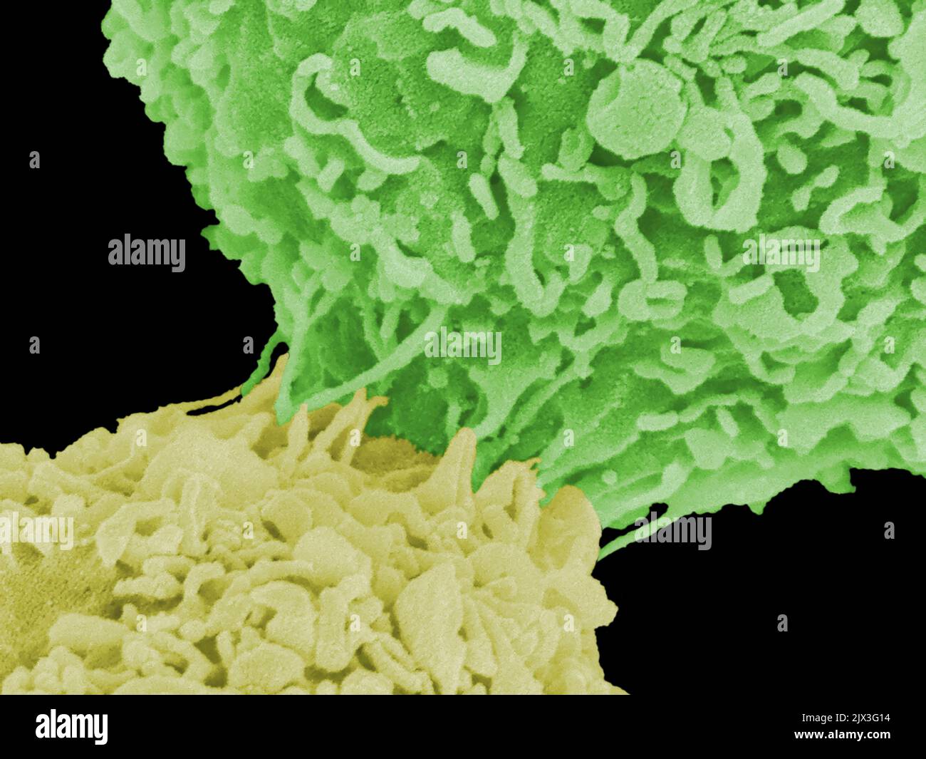 Images not to be used by the tobacco industry. Close-up of lung cancer ...
