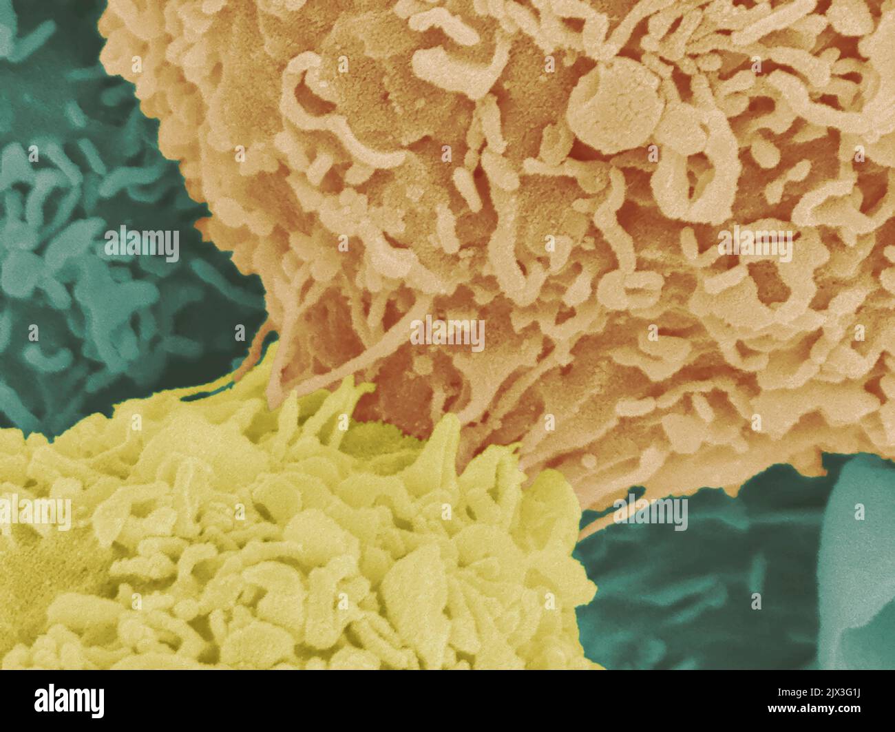 Images not to be used by the tobacco industry. Close-up of lung cancer ...