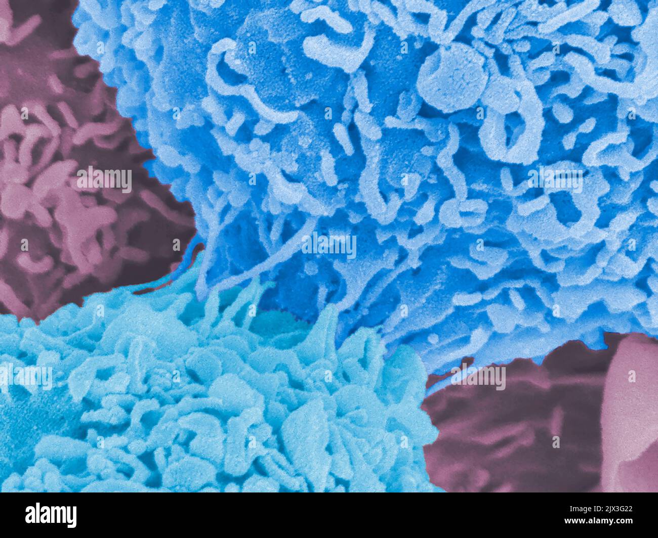 Images not to be used by the tobacco industry. Close-up of lung cancer ...