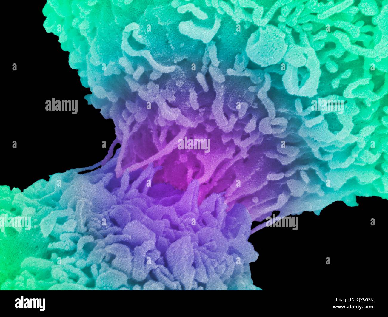 Images not to be used by the tobacco industry. Close-up of lung cancer ...