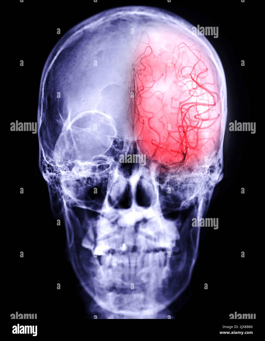 Cerebral angiography image from Fluoroscopy with skull of human showing ...