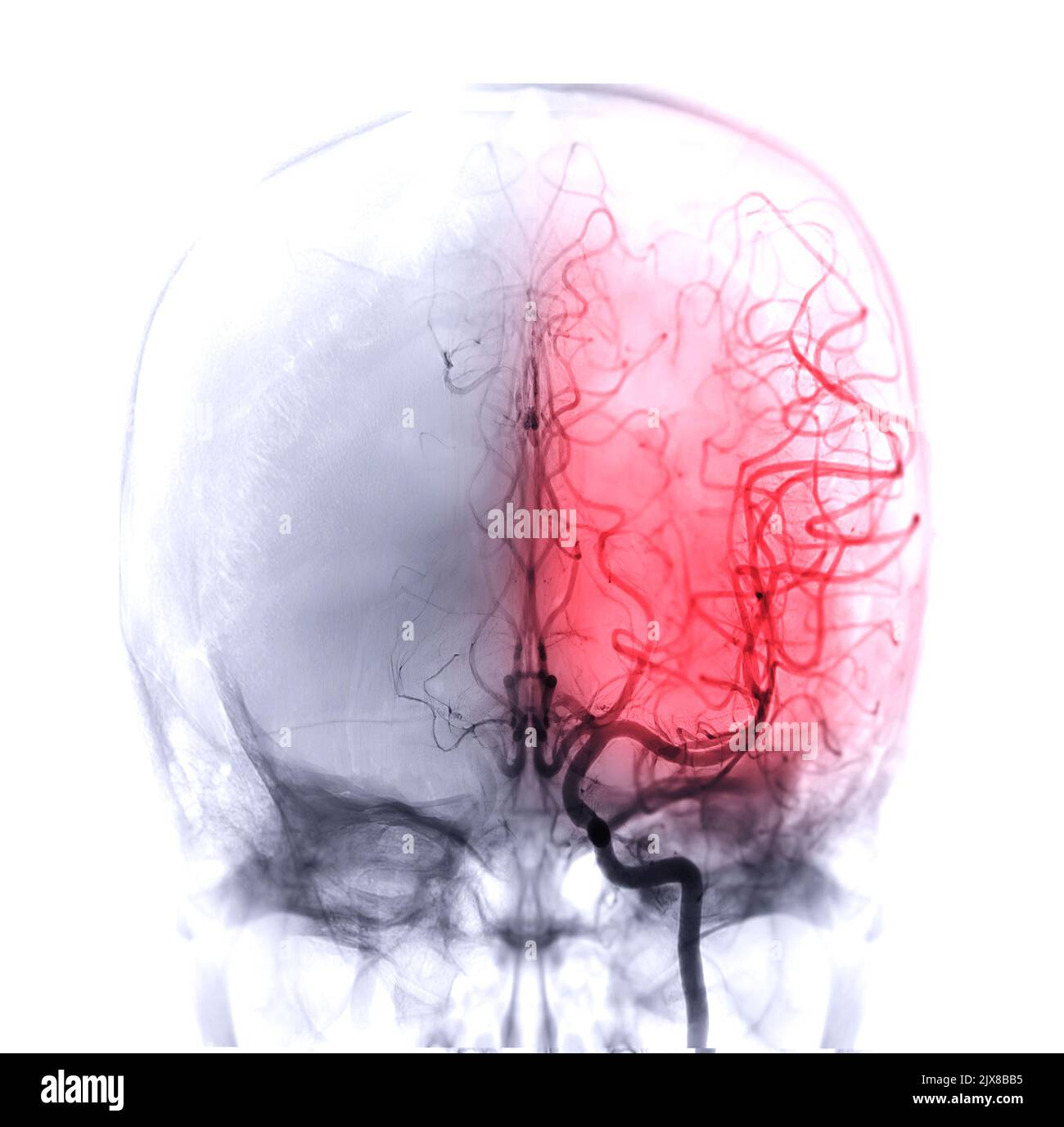 Cerebral angiography image from Fluoroscopy in intervention radiology ...