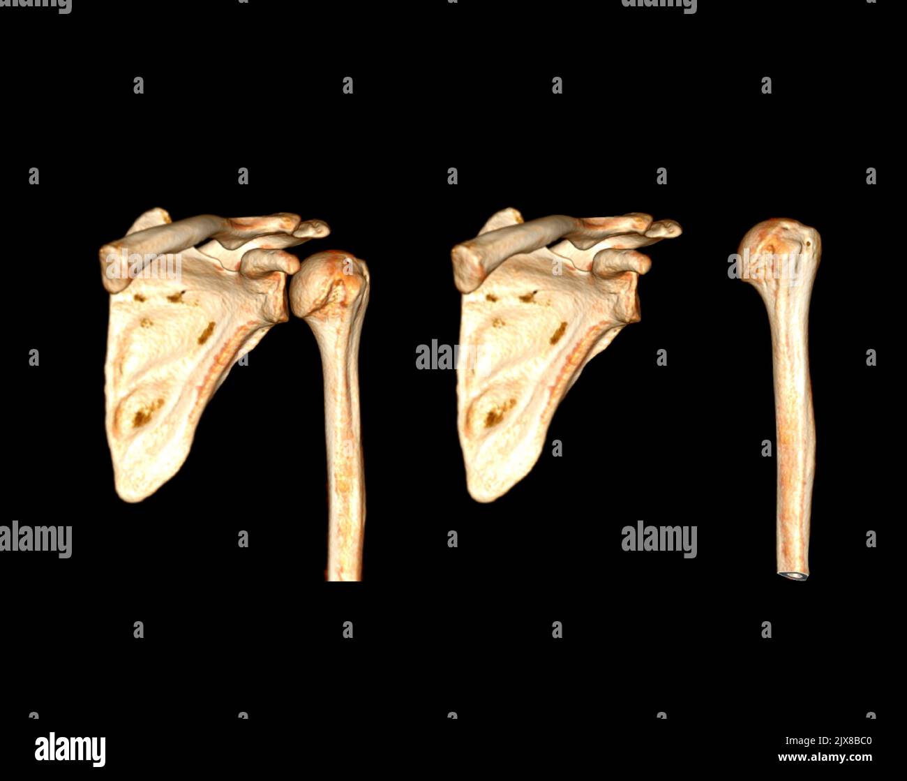 Computed Tomography Volume Rendering Examination Of The Shoulder 3d Rendering In Patient