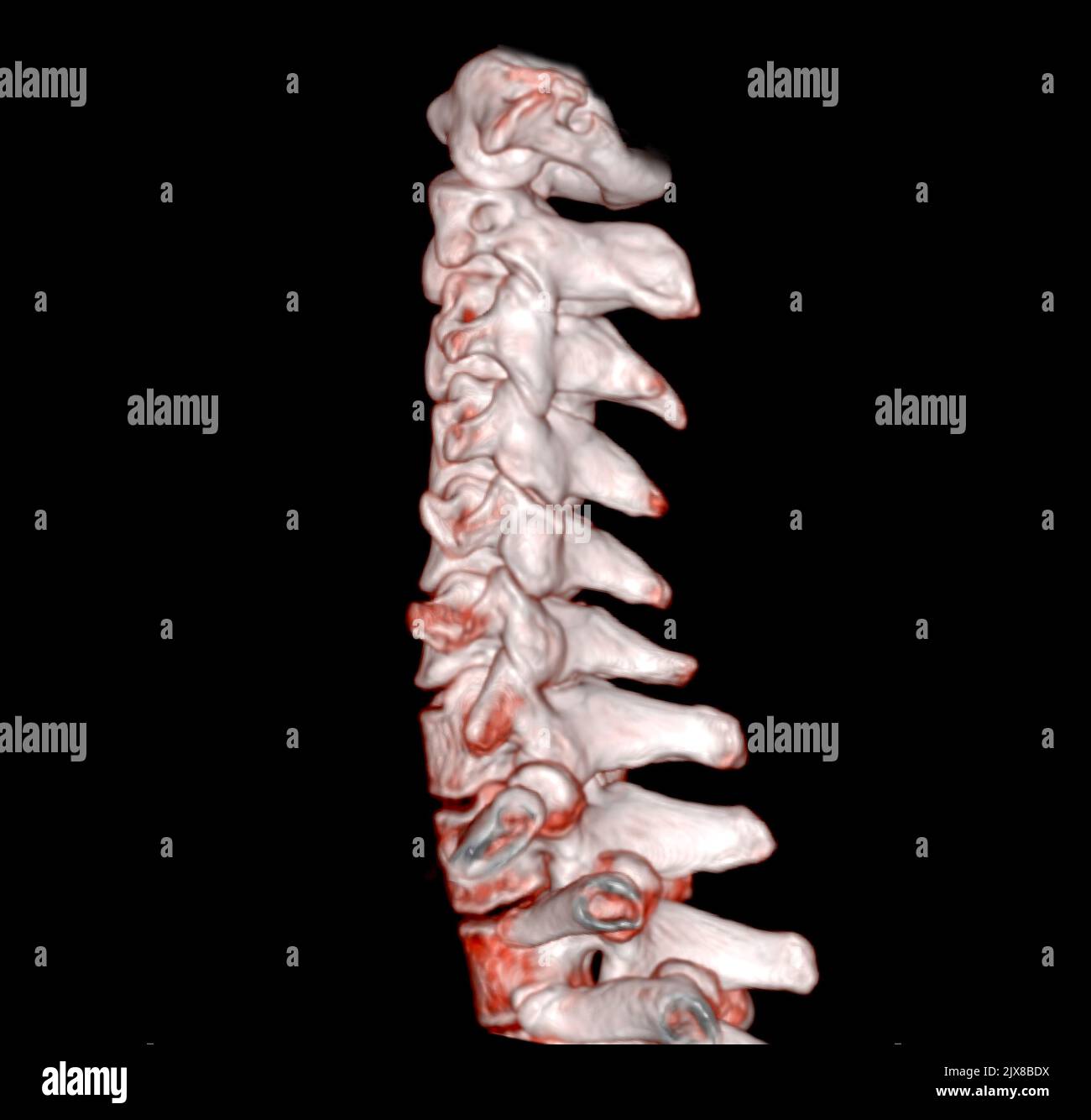 CT SCAN of Cervical Spine ( C-spine ) patient trauma case 3D rendering image Stock Photo - Alamy