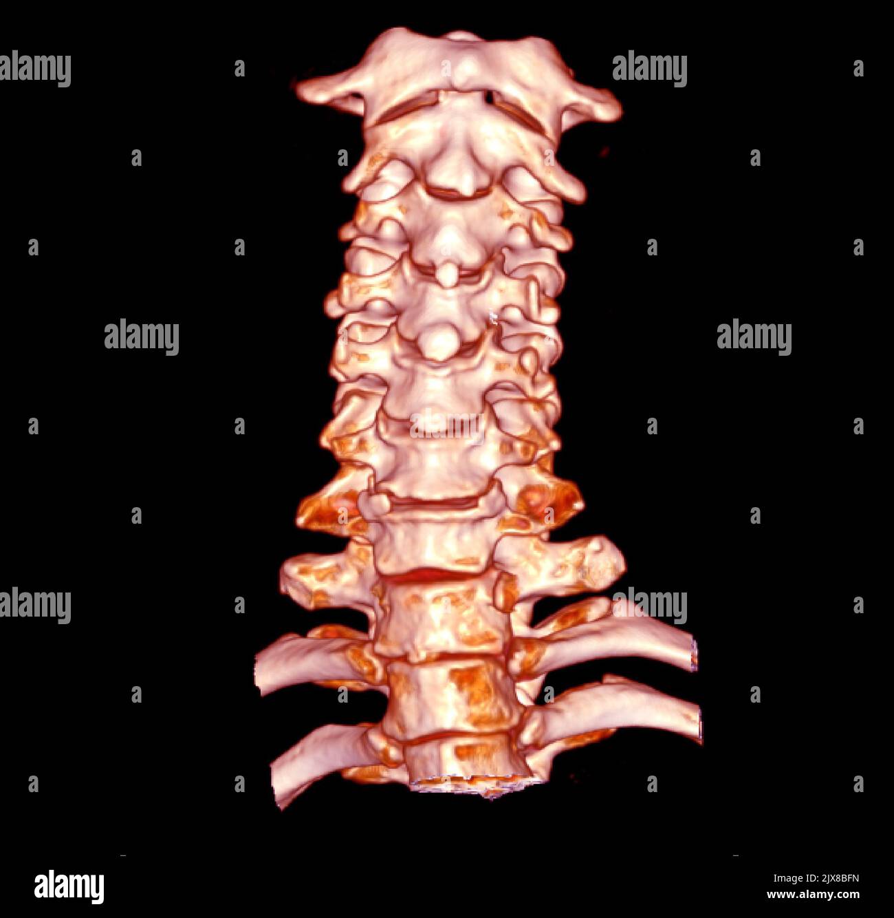 CT SCAN of Cervical Spine ( C-spine ) patient trauma case 3D rendering ...