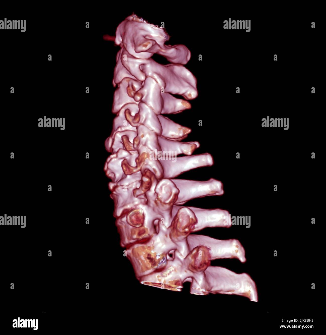 CT SCAN of Cervical Spine ( C-spine ) patient trauma case 3D rendering ...