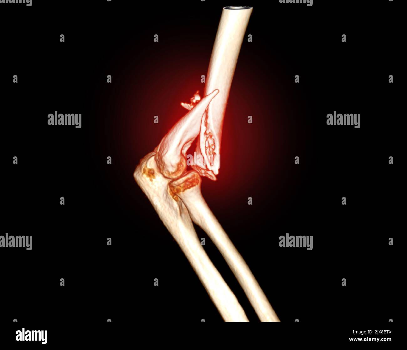 Computed Tomography Volume Rendering examination of elbow joint 3D ...