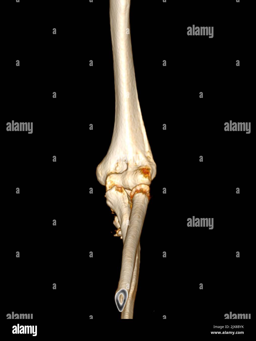 Computed Tomography Volume Rendering examination of elbow joint 3D ...