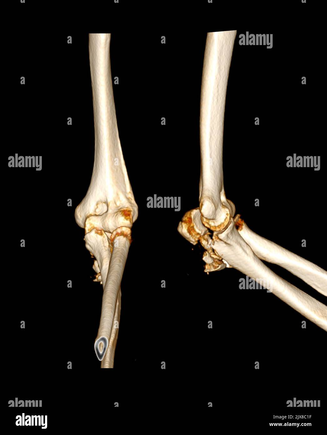 Computed Tomography Volume Rendering examination of elbow joint 3D ...