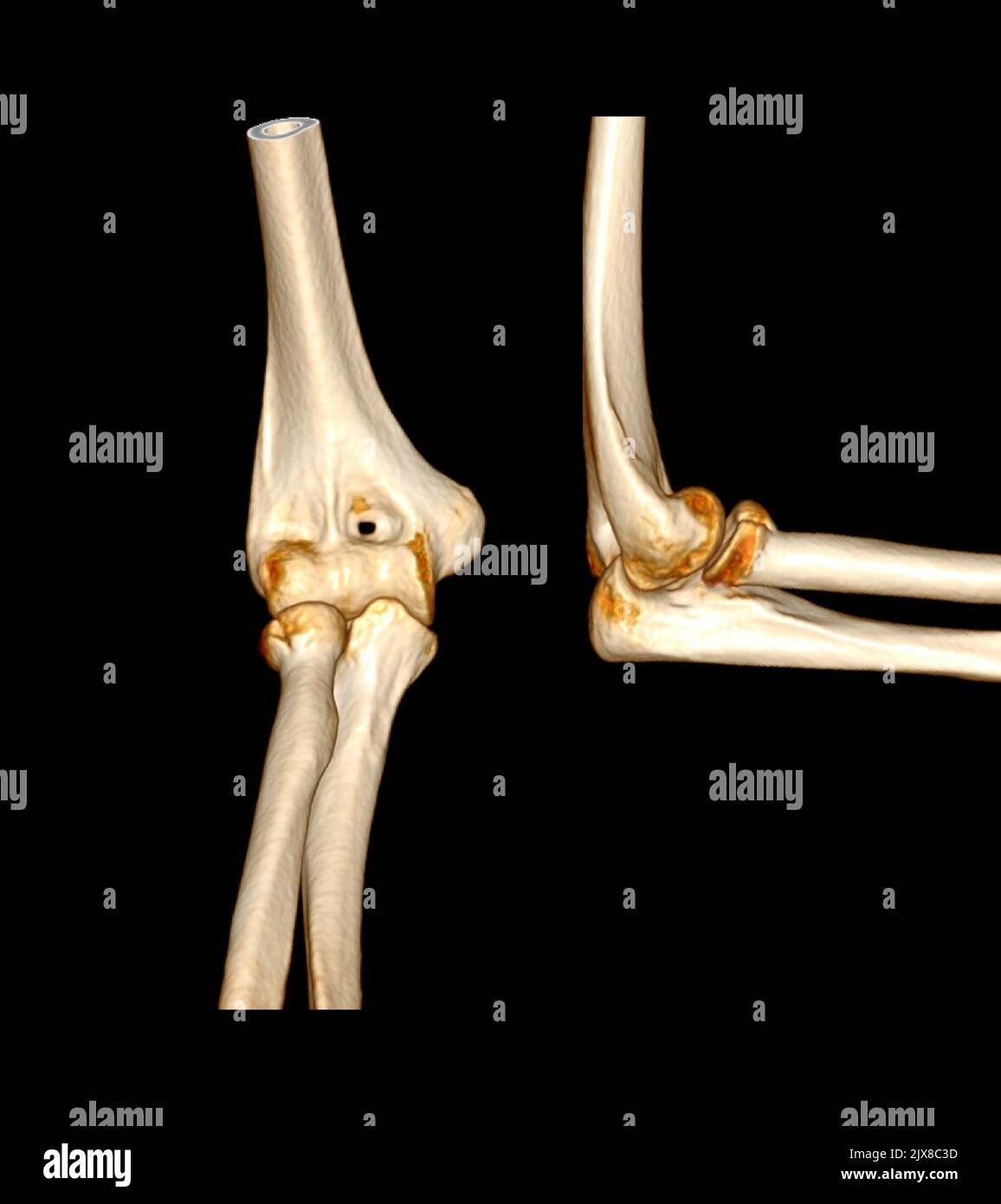 Computed Tomography Volume Rendering examination of elbow joint 3D ...