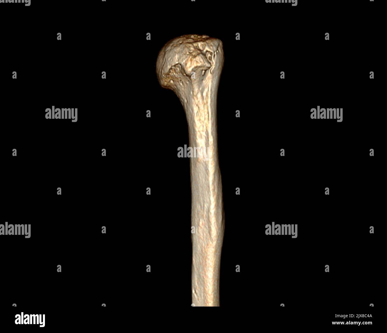 Computed Tomography Volume Rendering examination of the shoulder joint ...