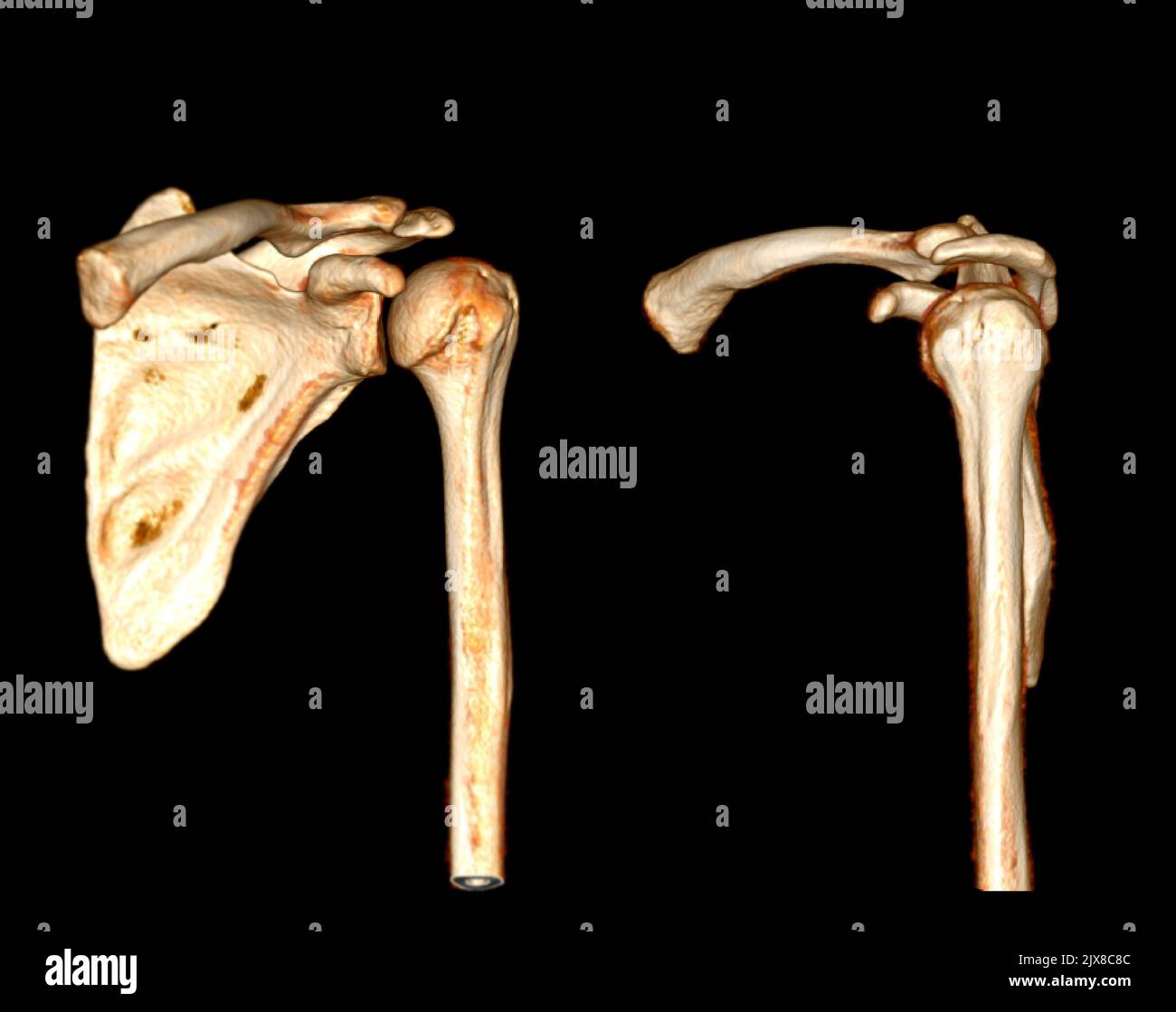 Computed Tomography Volume Rendering examination of the Shoulder 3D ...