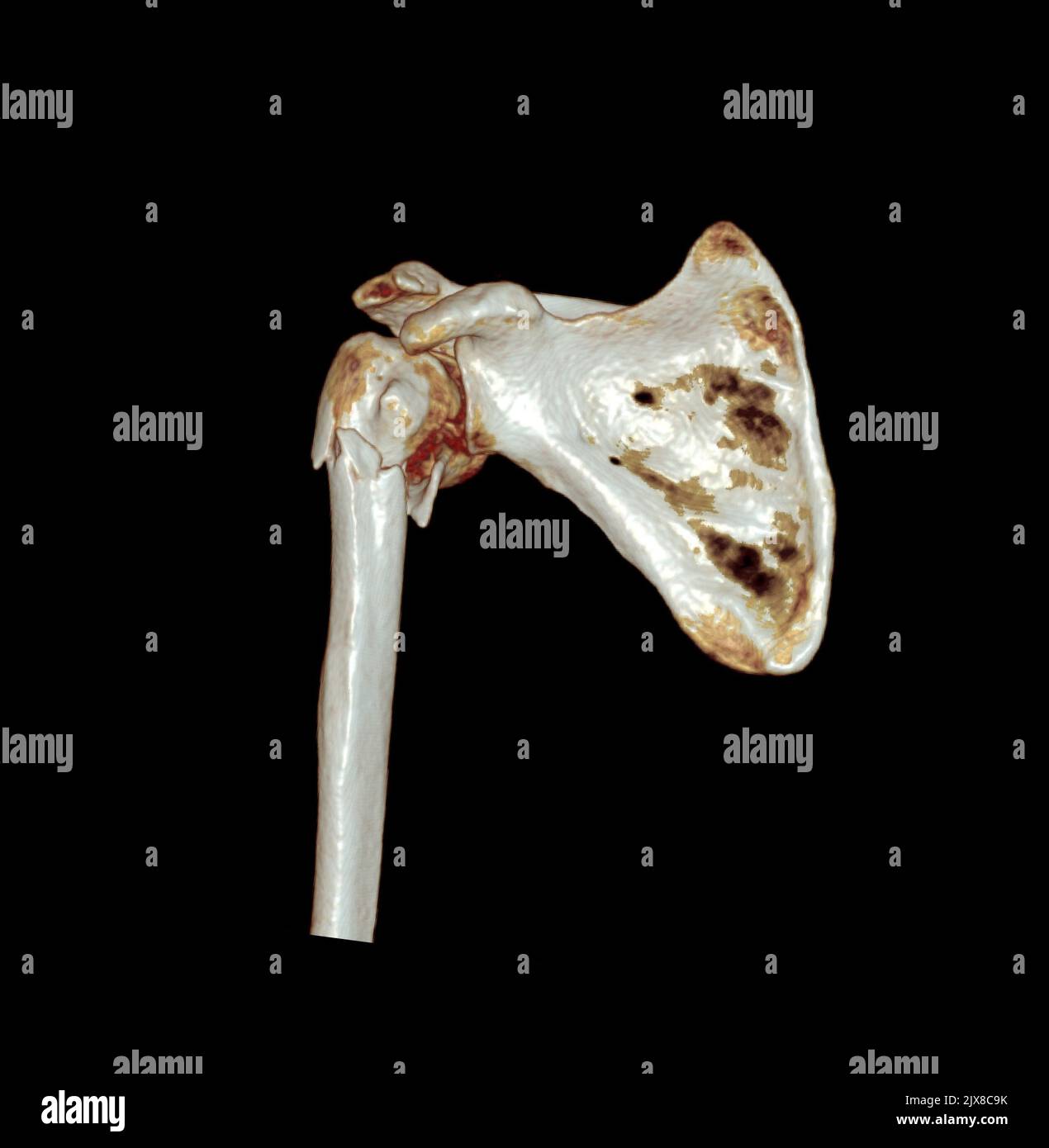 Computed Tomography Volume Rendering Examination Of The Shoulder 3d Rendering In Patient