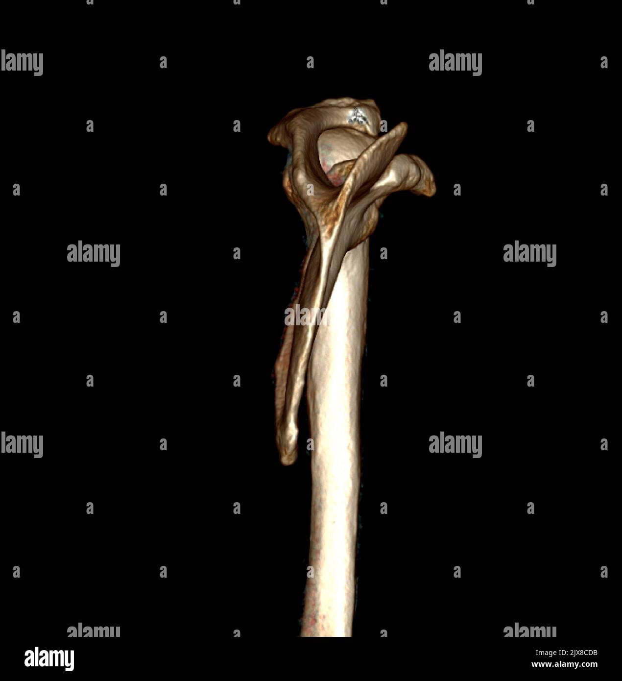 Computed Tomography Volume Rendering examination of the shoulder joint ...