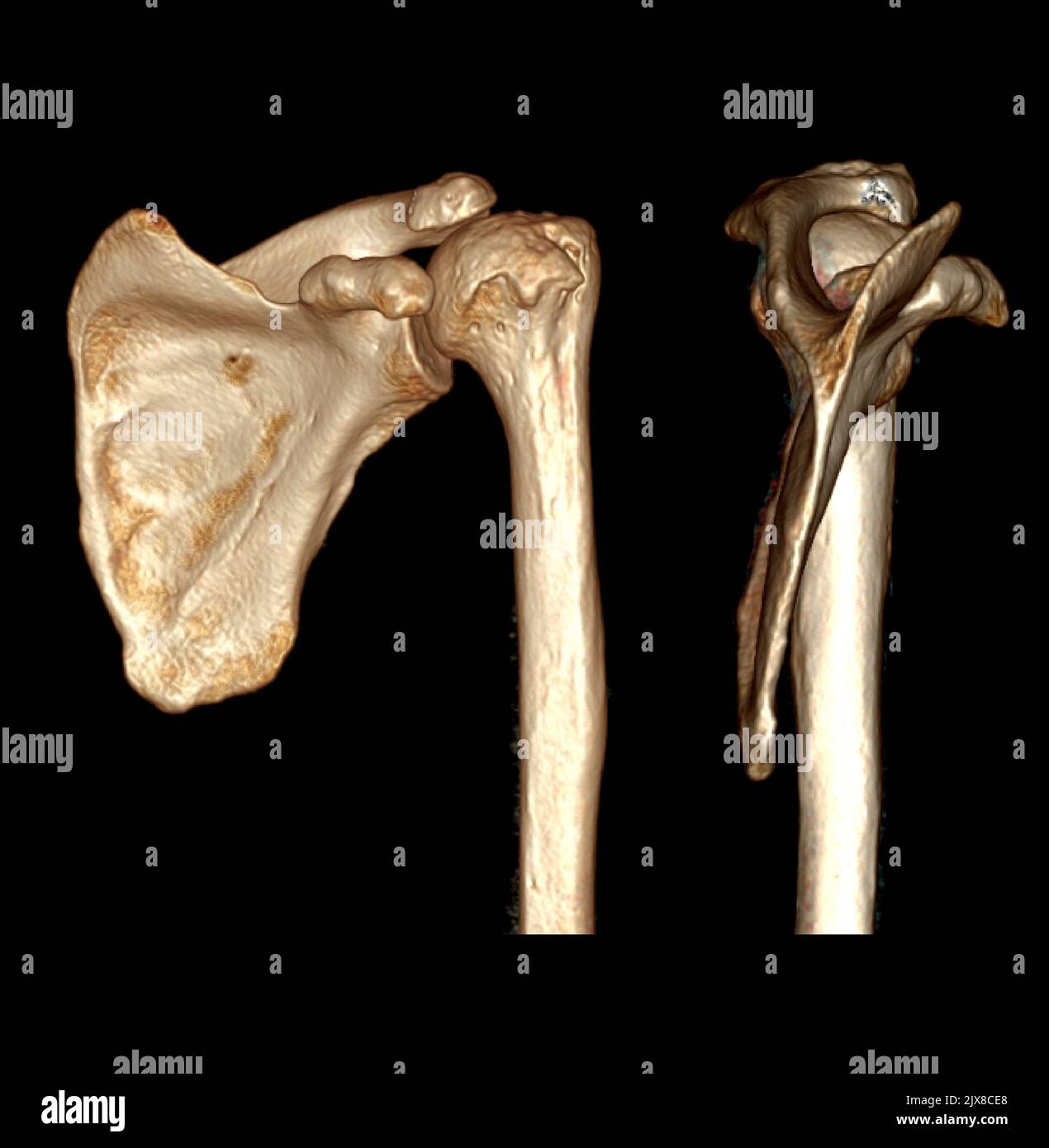 Computed Tomography Volume Rendering examination of the Shoulder 3D ...