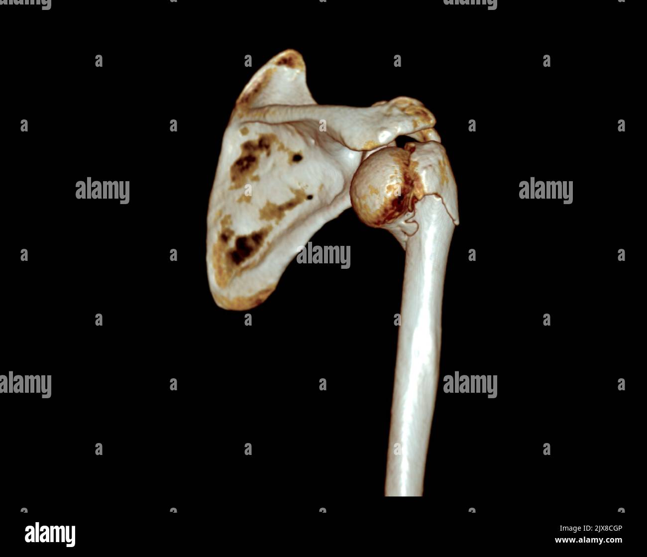 Computed Tomography Volume Rendering examination of the Shoulder 3D ...