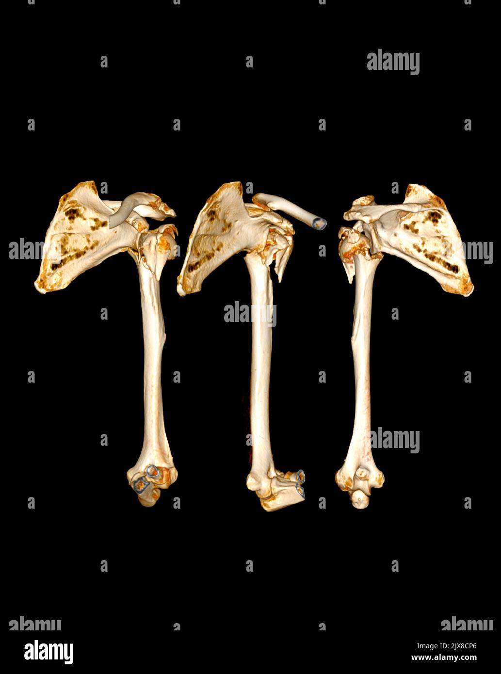 Computed Tomography Volume Rendering examination of the shoulder joint ...