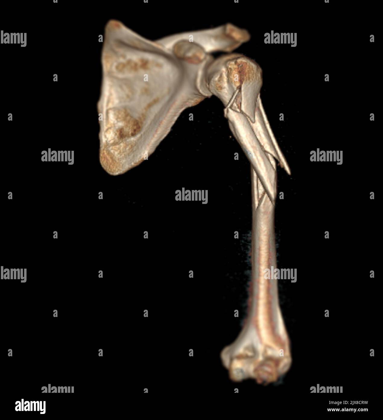 Computed Tomography Volume Rendering examination of the shoulder joint ...