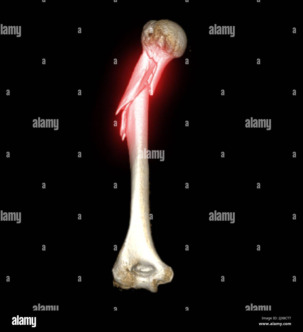 Computed Tomography Volume Rendering examination of the shoulder joint ...