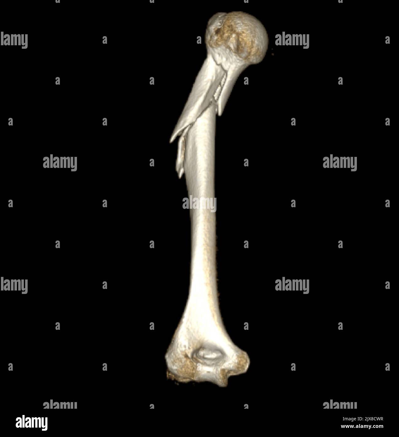 Computed Tomography Volume Rendering examination of the shoulder joint ...