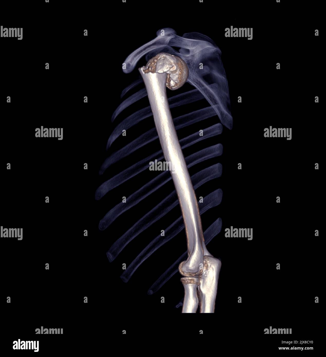 Computed Tomography Volume Rendering examination of the shoulder joint ...