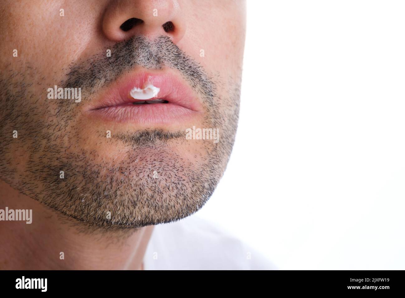 medical treatment with cold sore cream on a man's anonymous face Stock ...