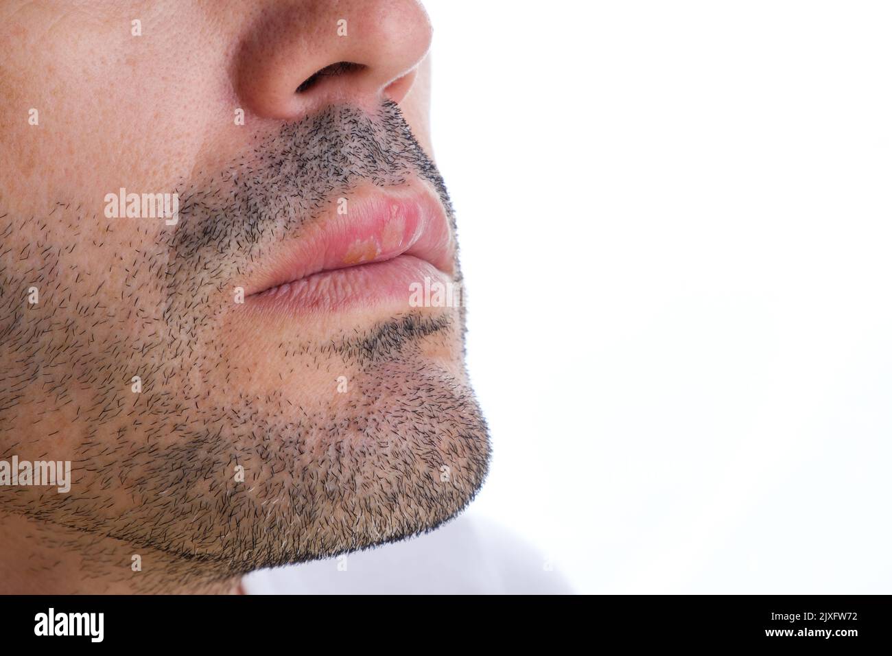 Cold sores close up hi-res stock photography and images - Alamy