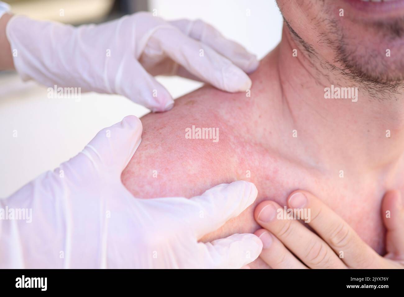 Doctor in gloves conducts initial examination of man with sunburn on ...