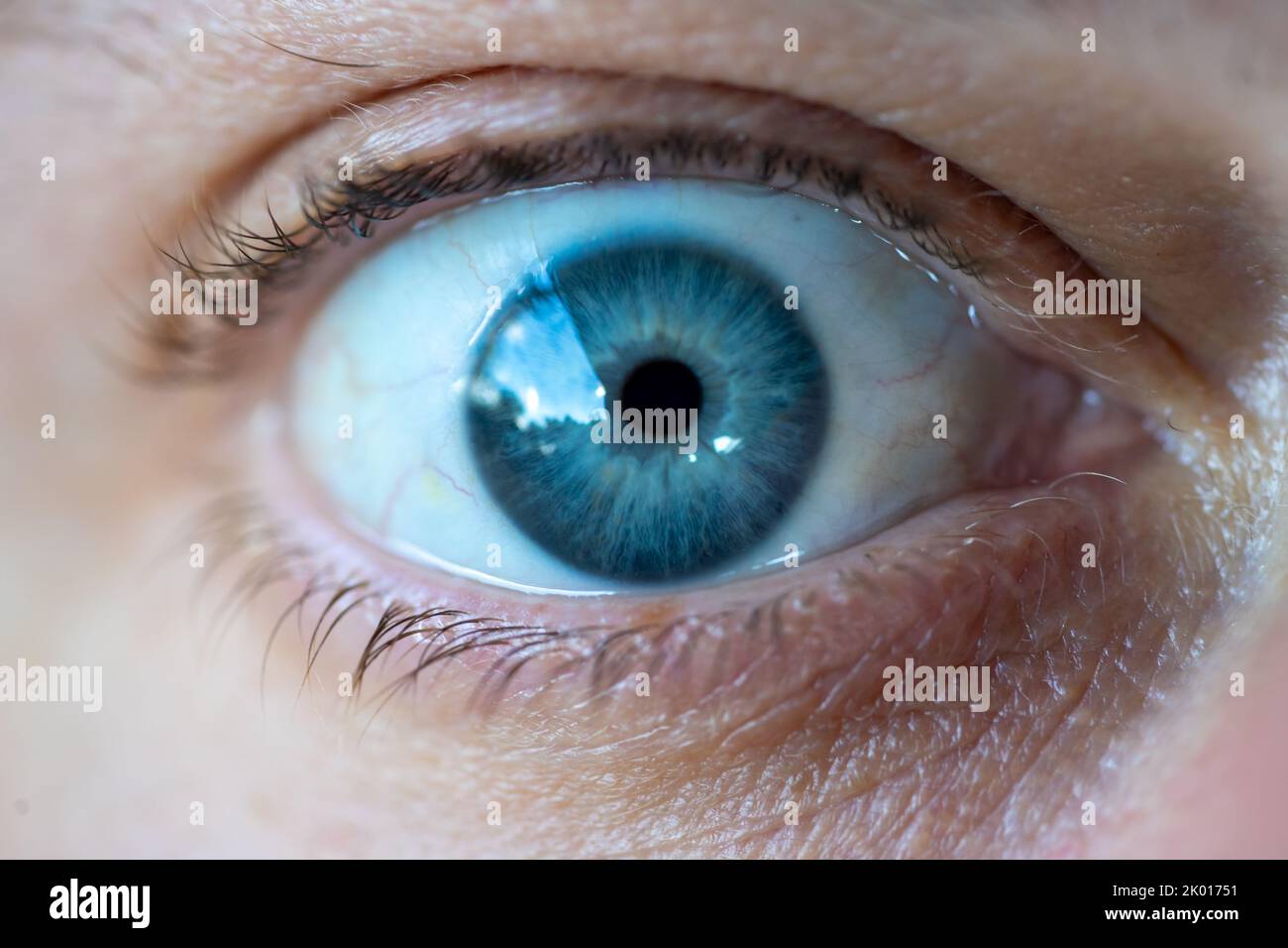 Black eye in detail at the ophthalmologist Stock Photo - Alamy