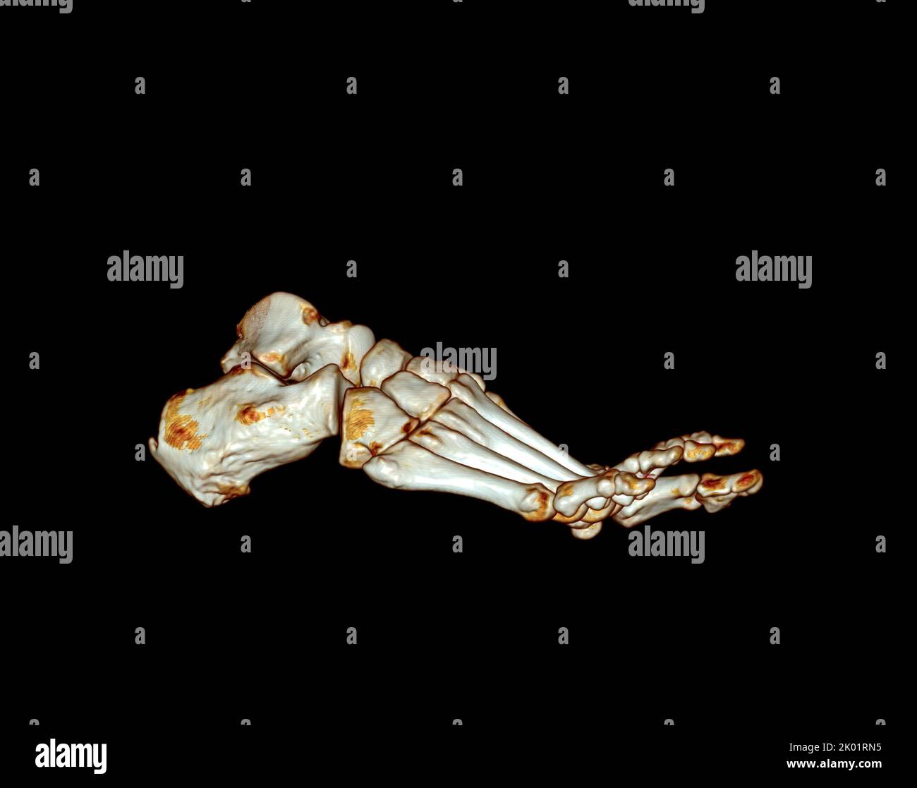 Computed Tomography Of The Foot 3d Volume Rendering Examination Of The
