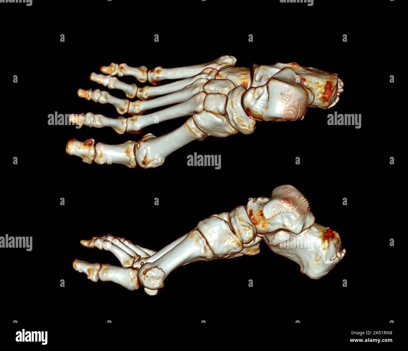 Computed Tomography of the Foot ,3D Volume Rendering examination of the ...