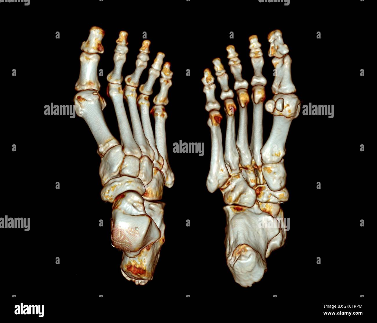 Computed Tomography Of The Foot 3d Volume Rendering Examination Of The Foot Ct Vr Foot 3d