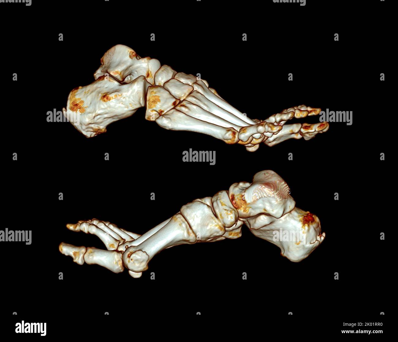 Computed Tomography of the Foot ,3D Volume Rendering examination of the ...