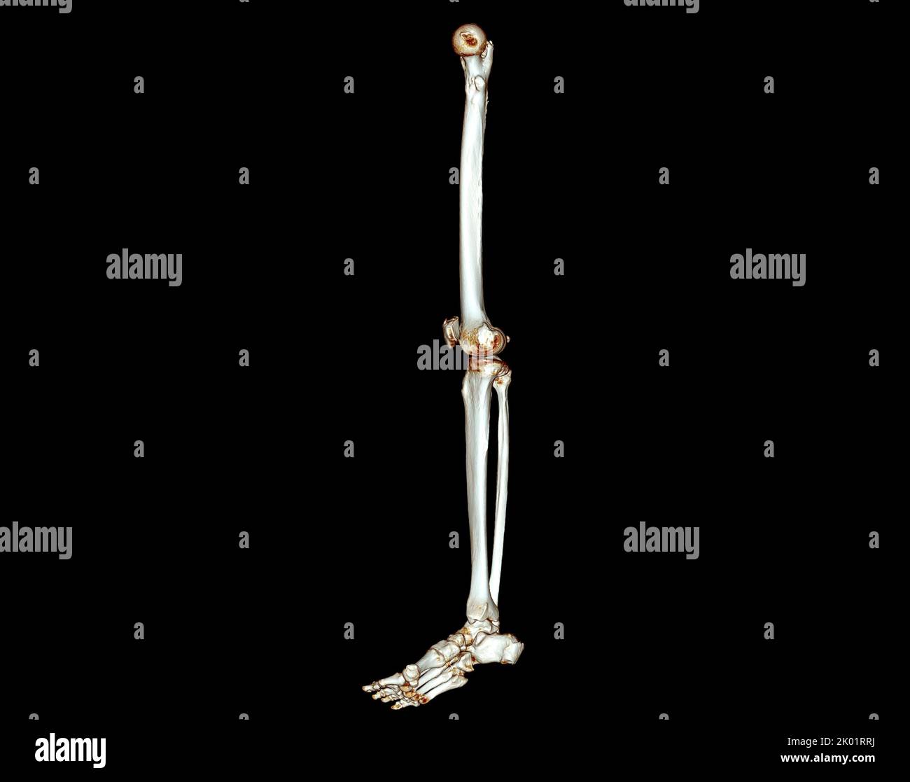 CT scan of lower extremity 3D for diagnosis fracture of Femur bone ...