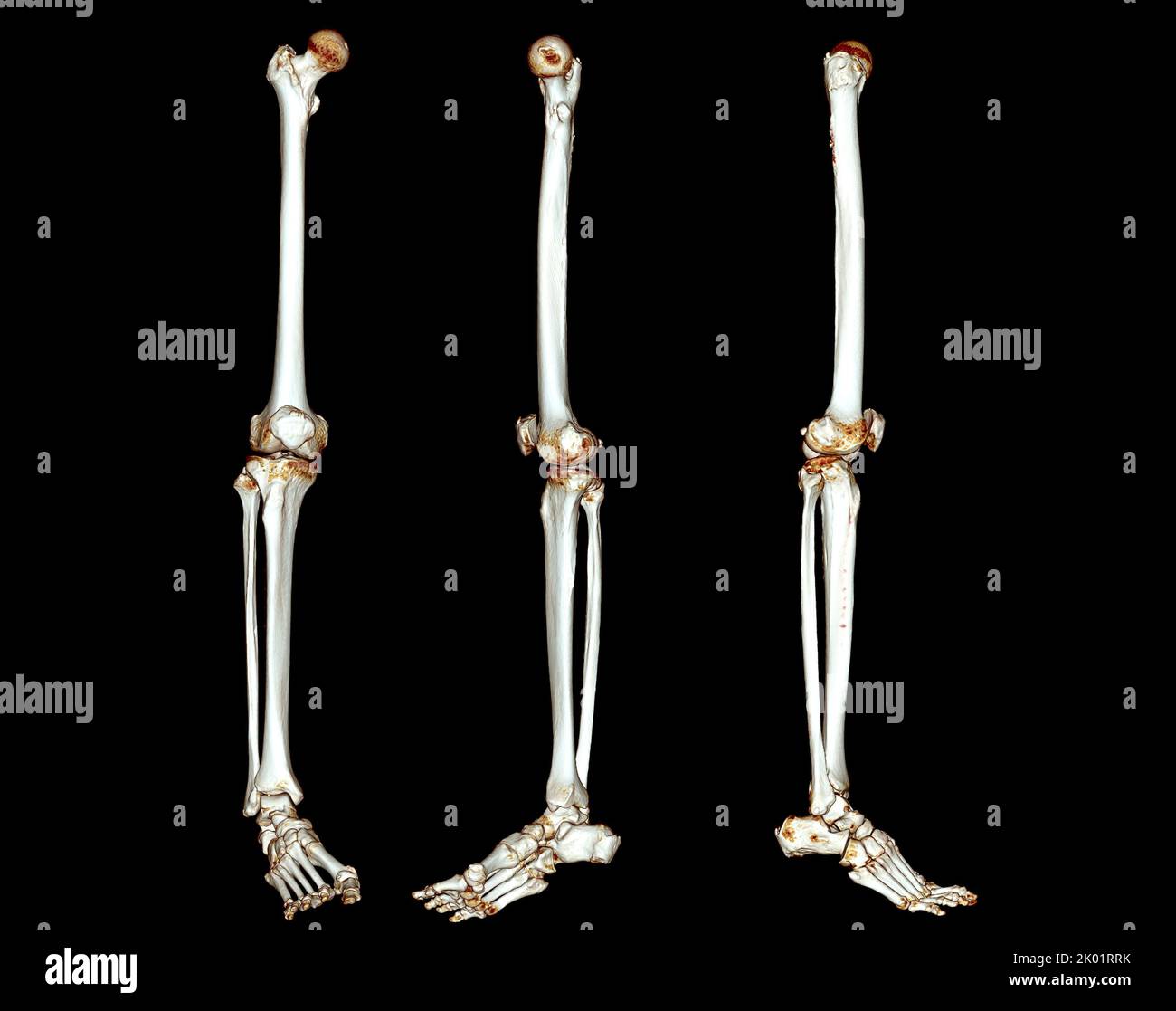 CT scan of lower extremity 3D for diagnosis fracture of Femur bone ...