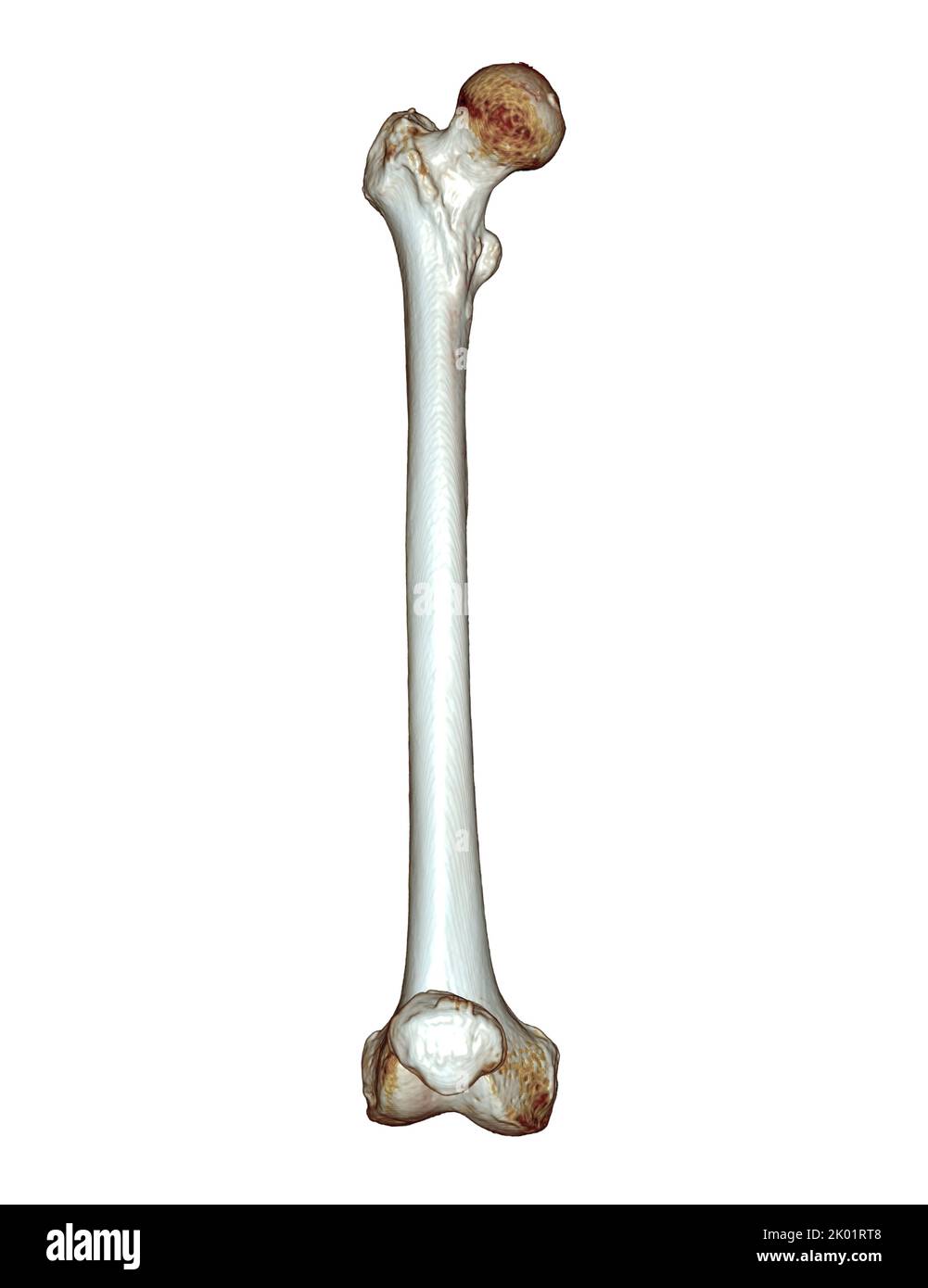 CT scan of Femur bone og thigh bone 3D rendering for diagnosis fracture ... CT scan of Femur bone og thigh bone 3D rendering for diagnosis fracture ...