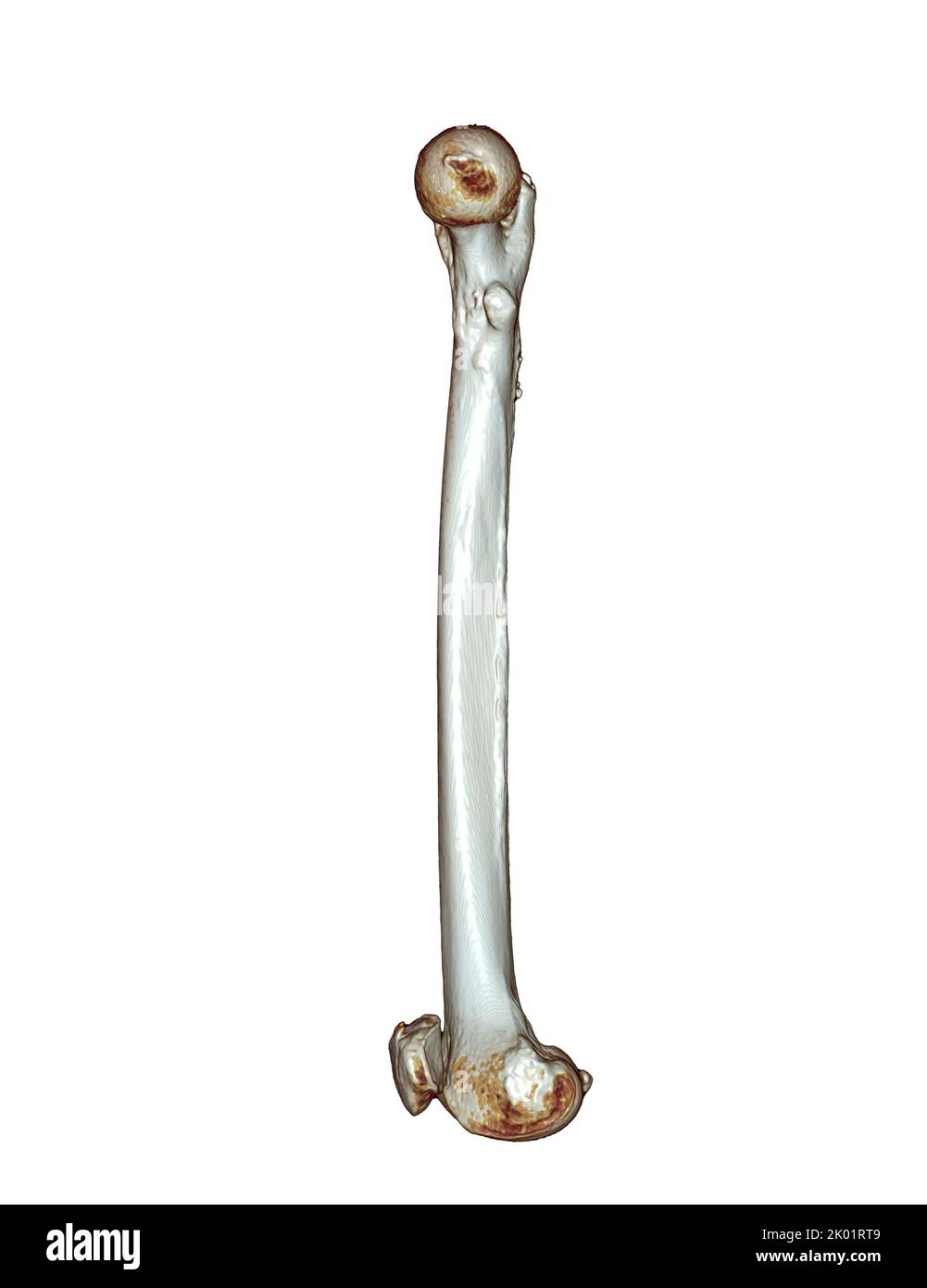 CT scan of Femur bone og thigh bone 3D rendering for diagnosis fracture ... CT scan of Femur bone og thigh bone 3D rendering for diagnosis fracture ...