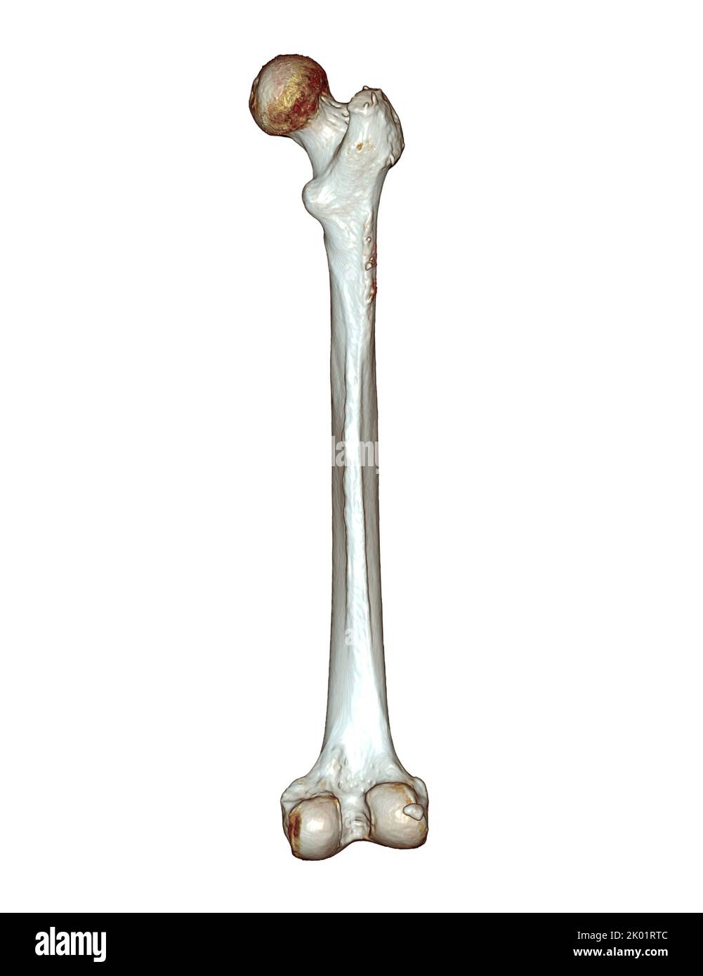 CT scan of Femur bone og thigh bone 3D rendering for diagnosis fracture ... CT scan of Femur bone og thigh bone 3D rendering for diagnosis fracture ...