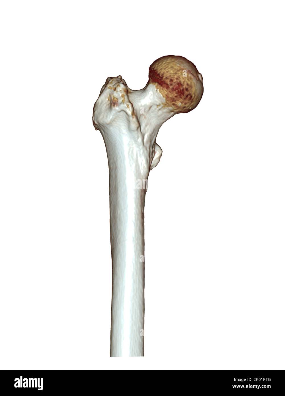 CT scan of Femur bone og thigh bone 3D rendering for diagnosis fracture ... CT scan of Femur bone og thigh bone 3D rendering for diagnosis fracture ...