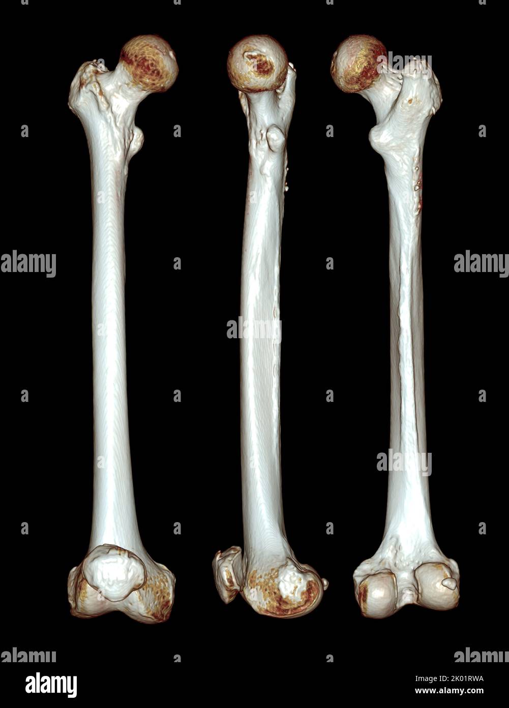 CT scan of Femur bone og thigh bone 3D rendering for diagnosis fracture ...