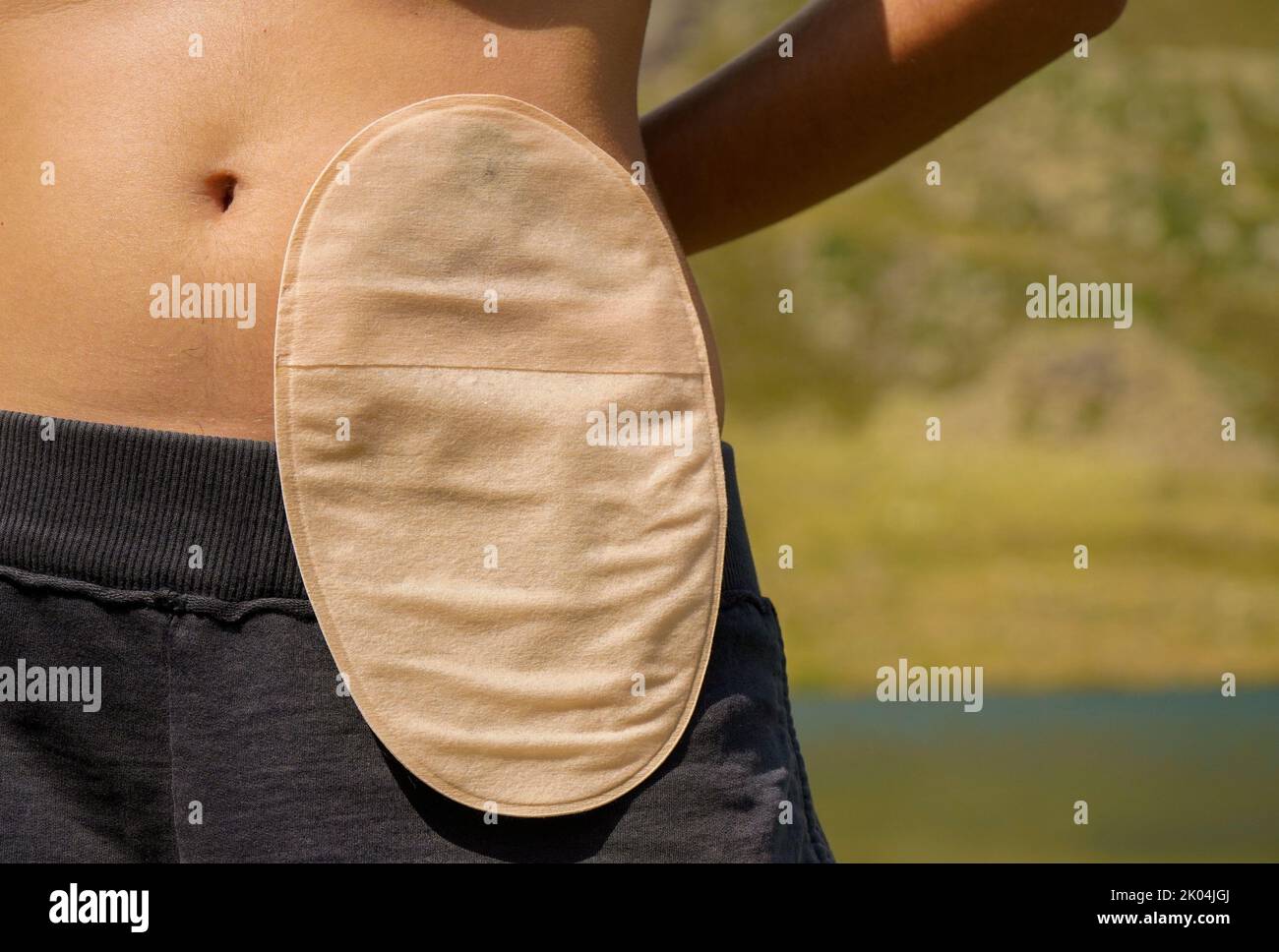 Stoma bag on the abdomen of a girl in the mountains. Colostomy in ...