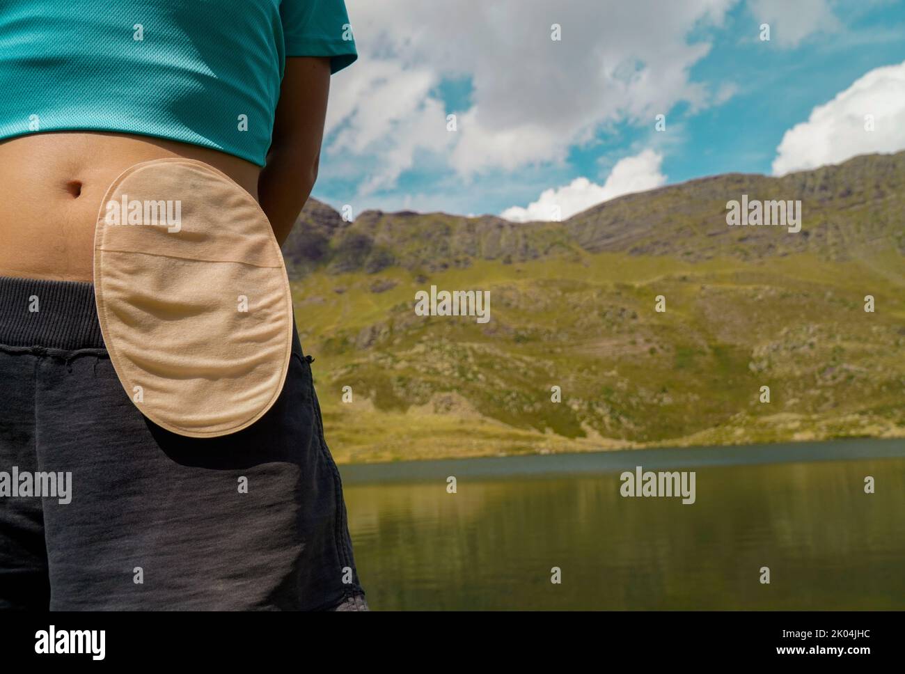 Colostomy care hi-res stock photography and images - Alamy