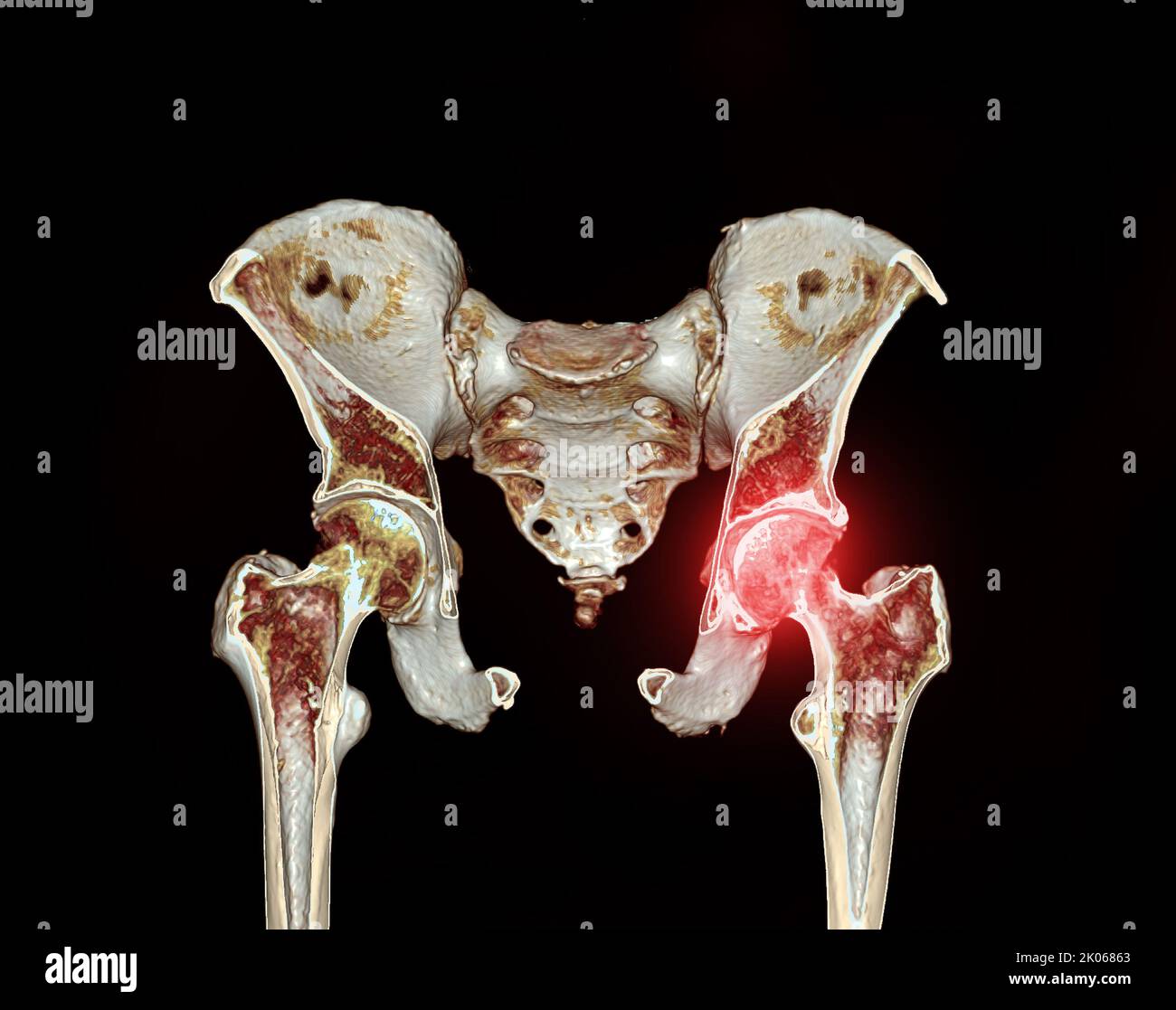 Ct Scan Of Pelvic Bone And Hip Joint 3d Rendering For Diagnosis Fracture Of Pelvic Bone And Hip