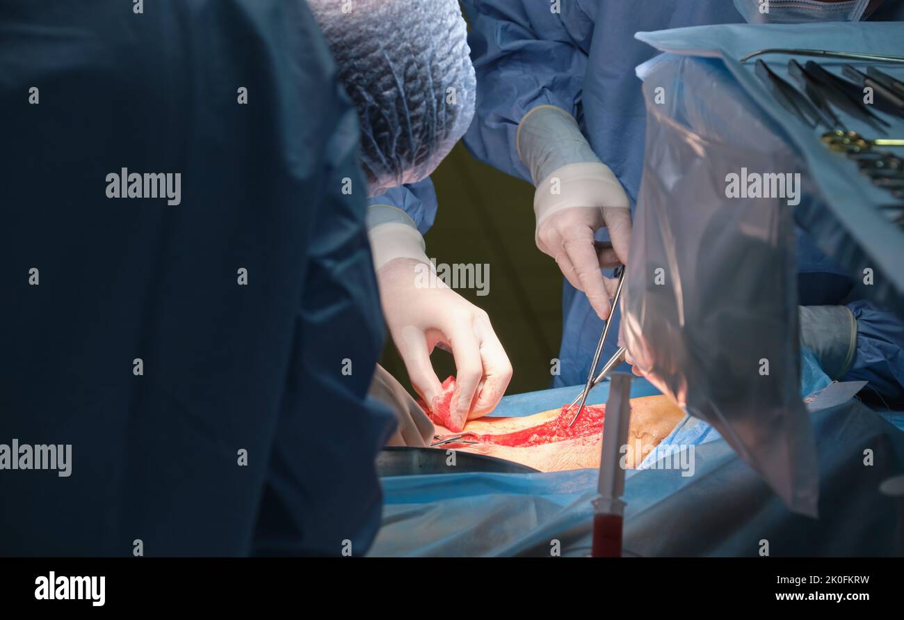 Team of professional doctors operating a patient conducting open cut ...