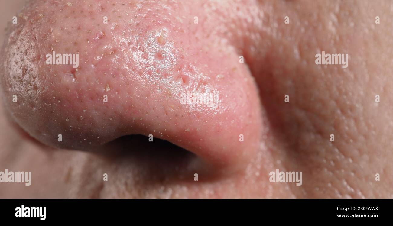 Acne and problem pores. Squeezing blackhead pimple with stainless steel ...