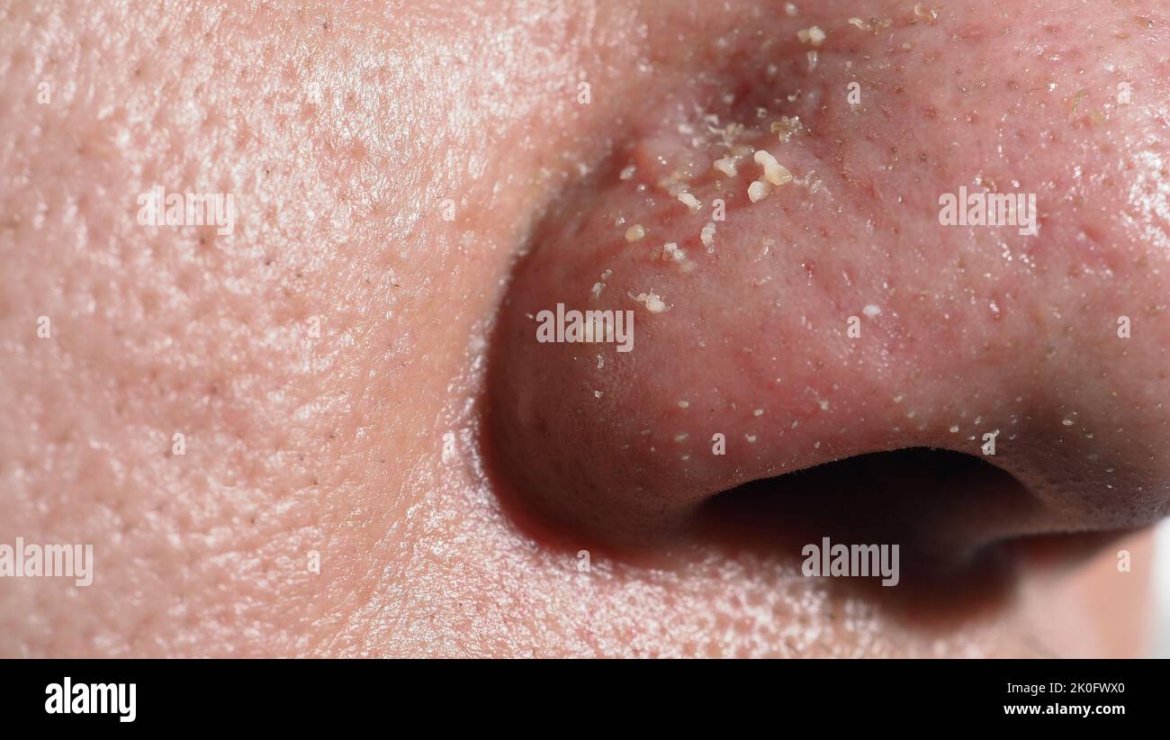 Acne and problem pores. Squeezing blackhead pimple with stainless steel ...