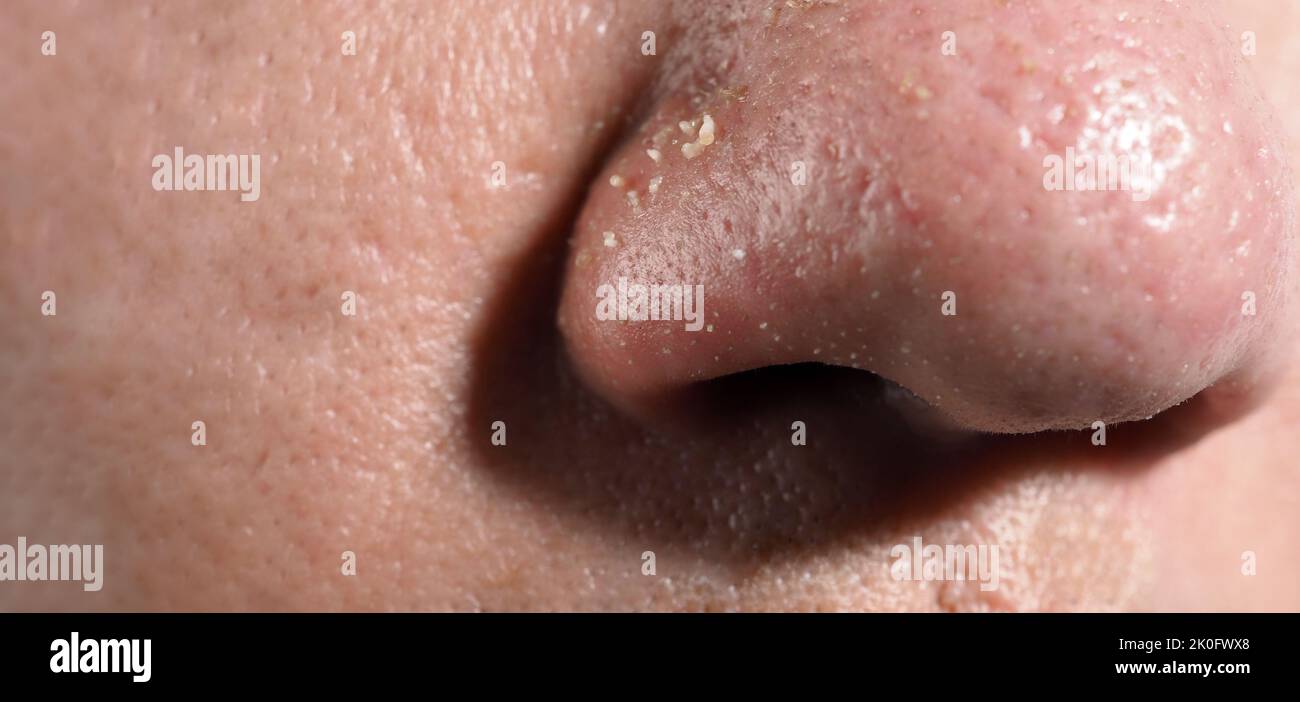 Acne and problem pores. Squeezing blackhead pimple with stainless steel ...