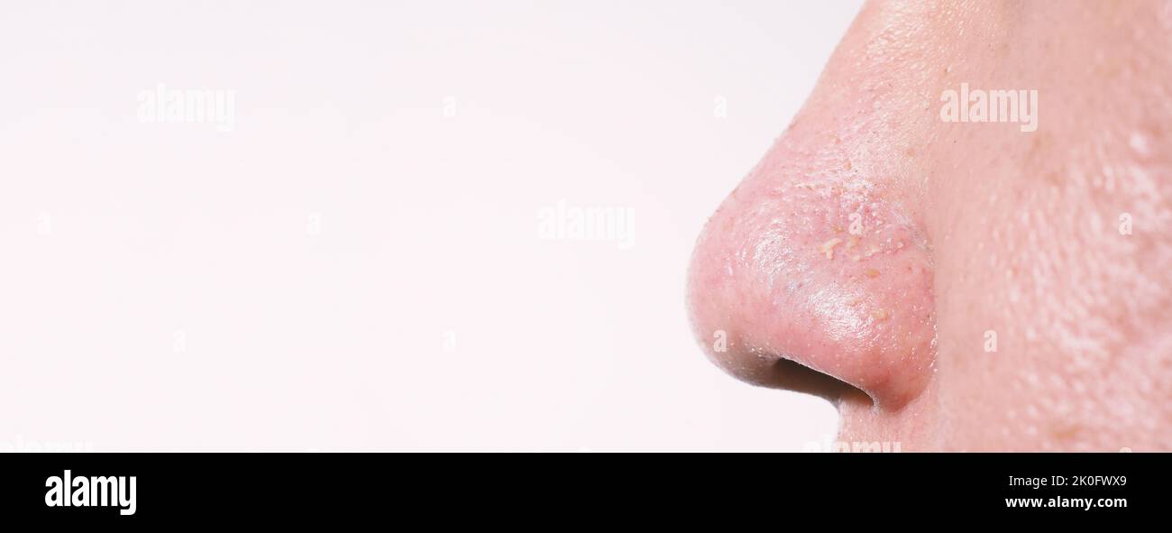Squeezing red nose hi-res stock photography and images - Alamy