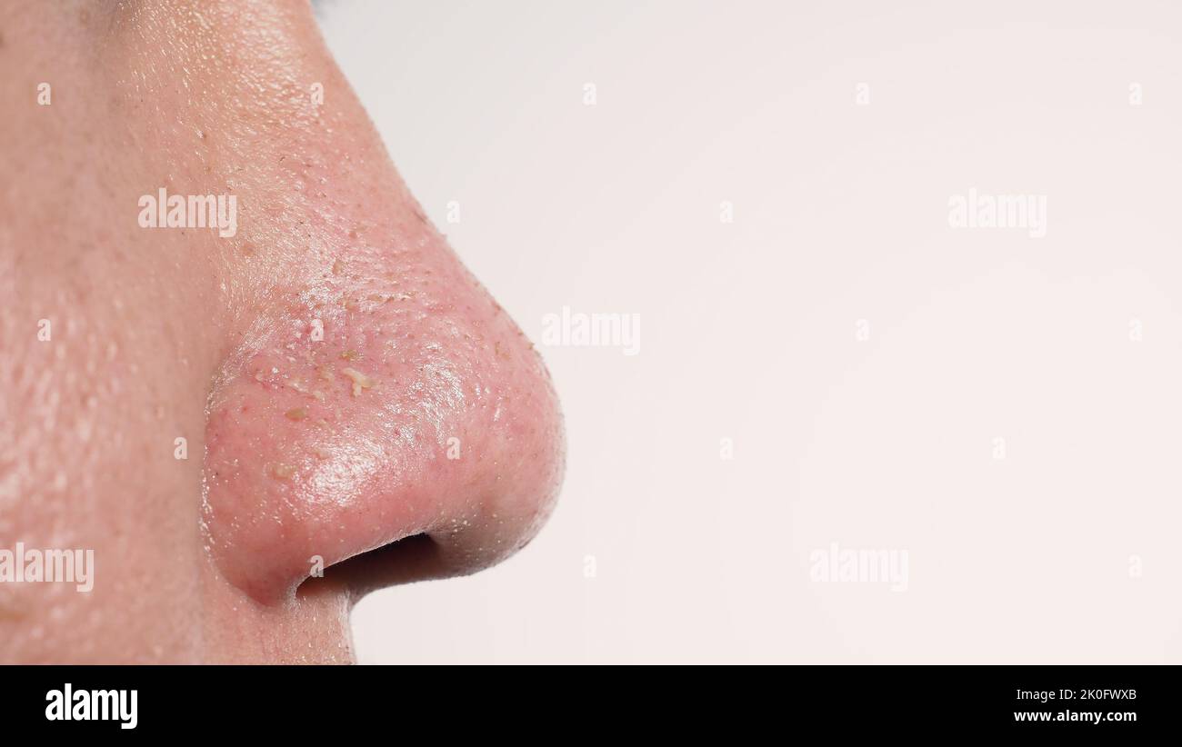 Acne and problem pores. Squeezing blackhead pimple with stainless steel ...