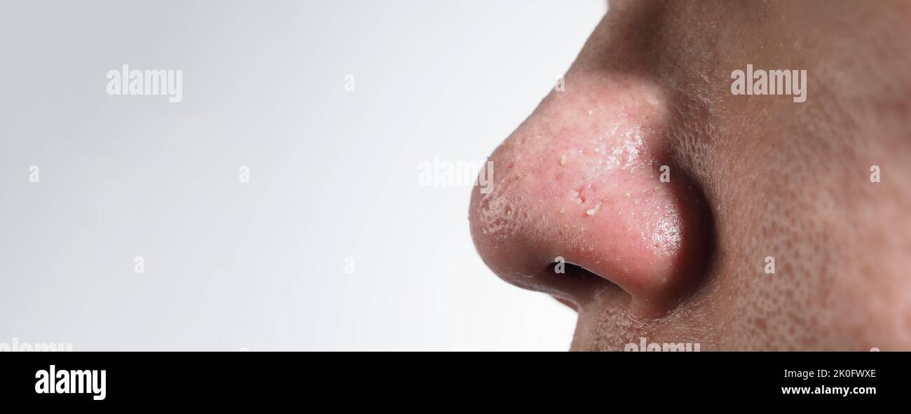Squeezing red nose hi-res stock photography and images - Alamy